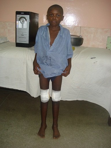 Give 40 Children in Asia the Ability to Walk! - GlobalGiving