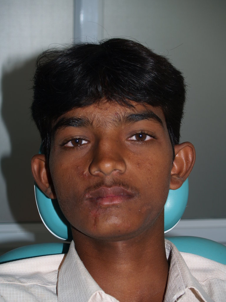 Smiling Faces - free reconstructive facial surgery - GlobalGiving