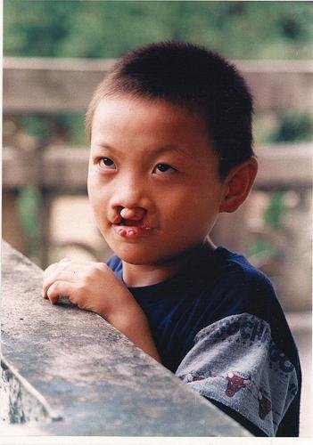 Free Cleft Surgery for 600 Poor Chinese Children - GlobalGiving
