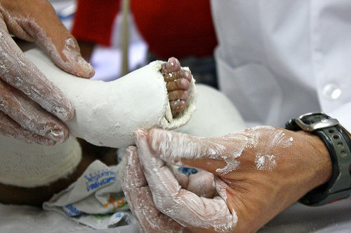 Support Clubfoot Treatment for 270 Children - GlobalGiving