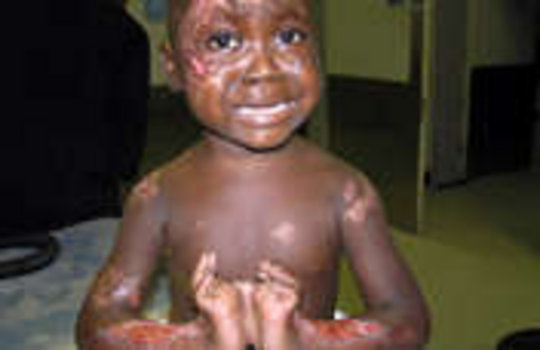 Free Surgery for 50 Burned Children in Zambia - GlobalGiving