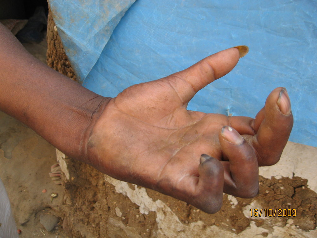 Free Medical Care for Poor Lepers - GlobalGiving