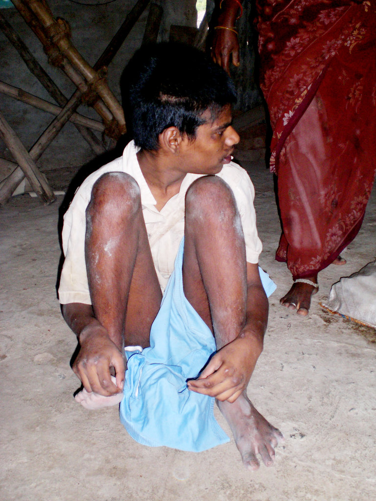 Deformed Leper & poor disable youth therapy Centre - GlobalGiving