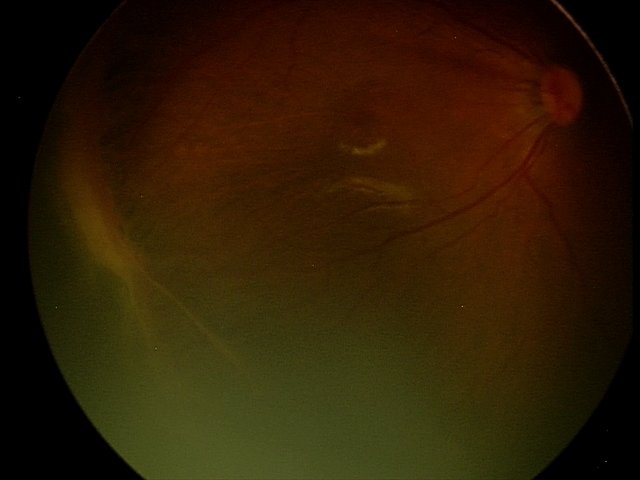 Reports on Eye Screening for Premature Babies - GlobalGiving