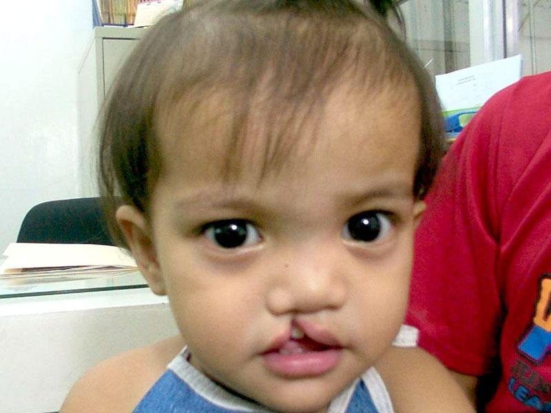 Reports on Free Cleft Surgery for 400 Filipino Children - GlobalGiving