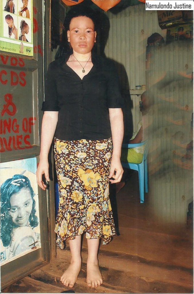 Build a School for 200 Children with Albinism - GlobalGiving