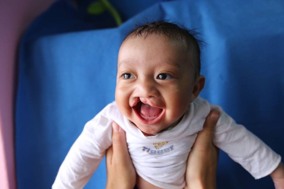 Surgery for 20 children born with cleft lip - GlobalGiving