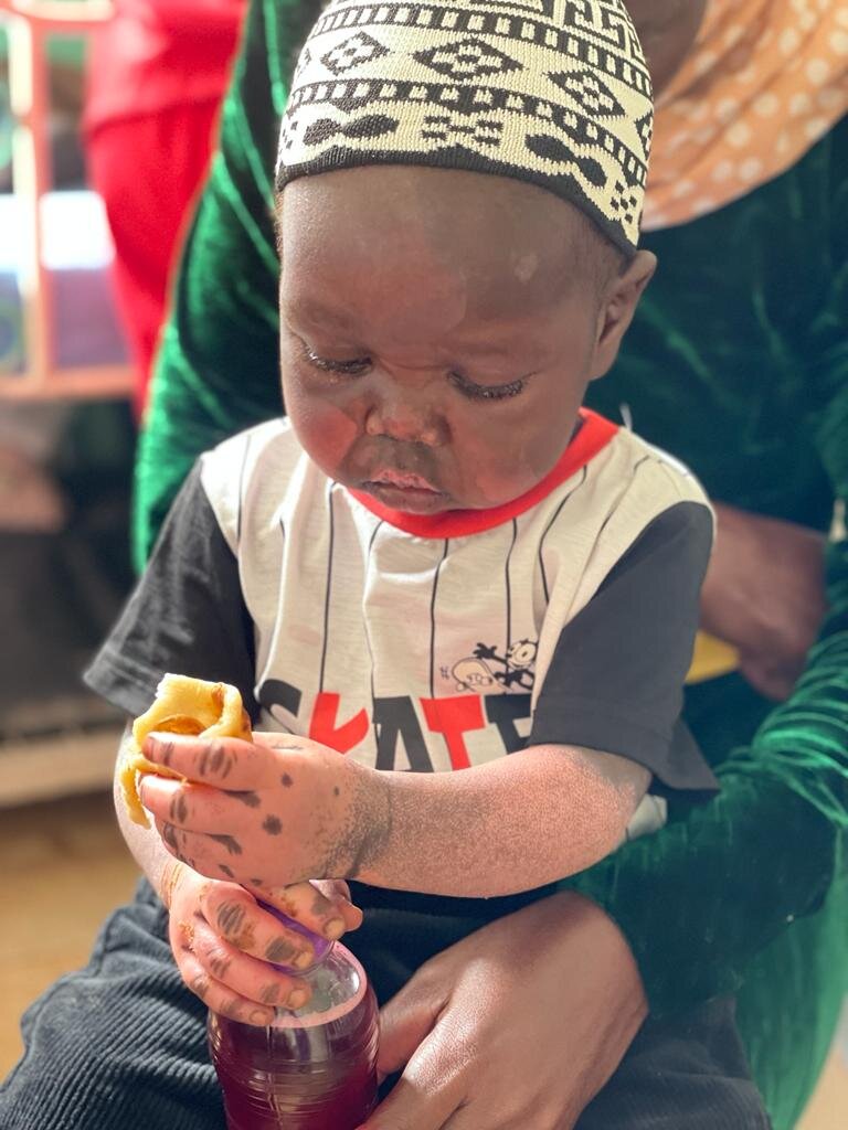 Help Fund a Children's Burn Unit in Uganda - GlobalGiving