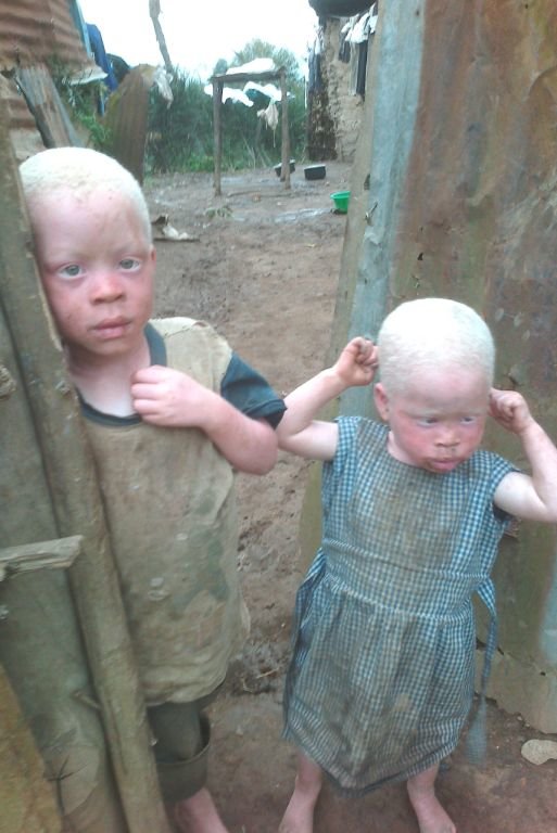 Save 80 Ugandan albinos from Skin Cancer - GlobalGiving
