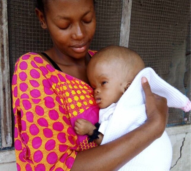 Heal 300 Kids with Hydrocephalus & BF in Tanzania - GlobalGiving